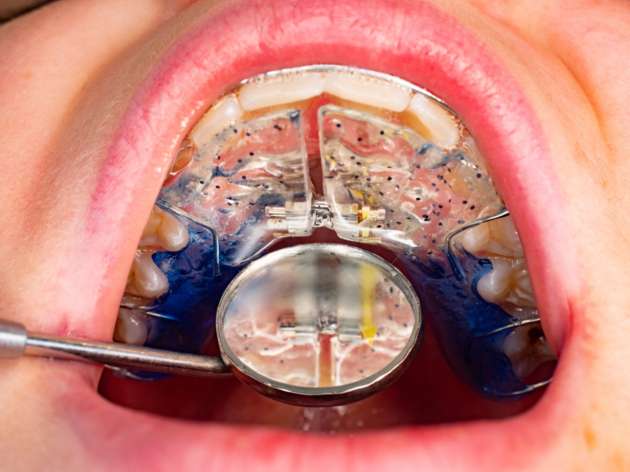 Palatal Expanders in Peoria, AZ